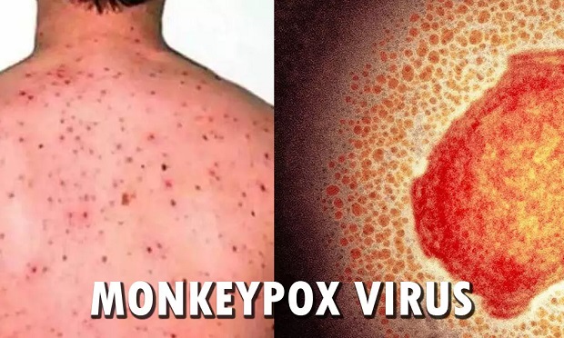 know the Symptoms of monkey pox in children
